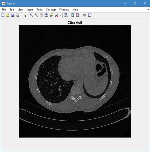 pengolahan citra ct scan | Pemrograman Matlab