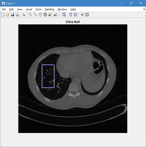Pengolahan Citra CT Scan Paru-Paru dengan Metode Segmentasi Active Contour | Pemrograman Matlab