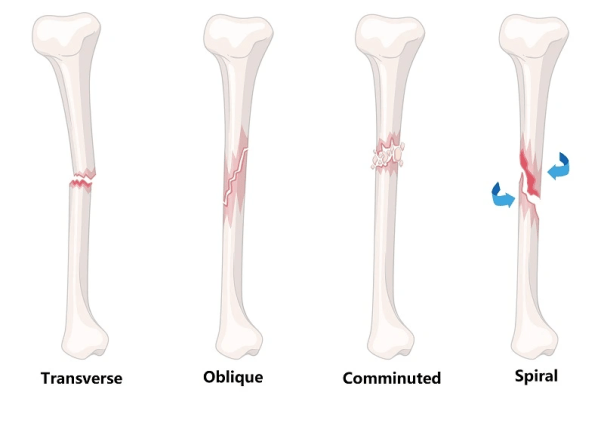Identifikasi Fraktur Tulang Tibia dan Fibula dengan Support Vector ...