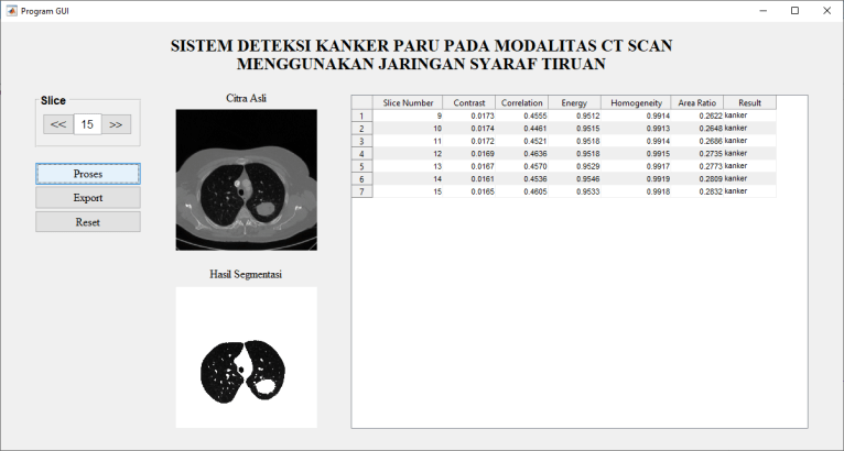 Deteksi Kanker Paru Menggunakan Jaringan Syaraf Tiruan pada Citra CT ...