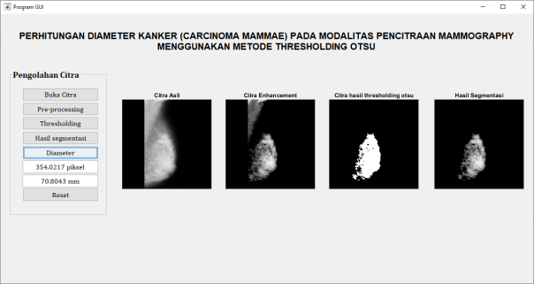 Perhitungan Diameter Kanker Payudara Menggunakan Metode Thresholding Otsu Pada Modalitas ...