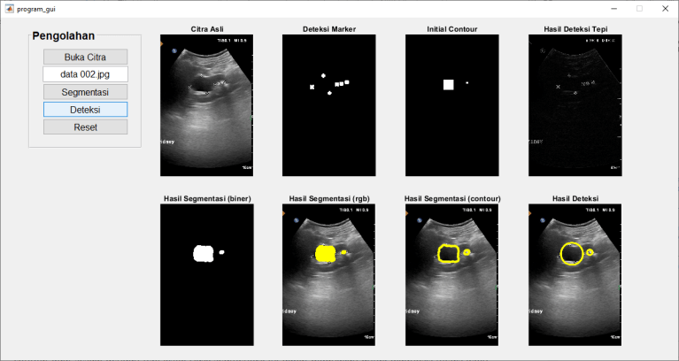 Segmentasi Citra Kista Ginjal Menggunakan Metode Active Contour ...