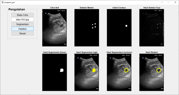 Segmentasi Citra Kista Ginjal Menggunakan Metode Active Contour ...