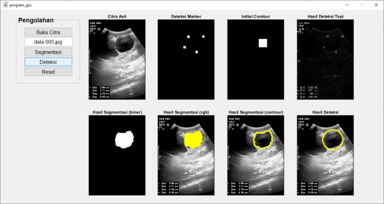 Segmentasi Citra Kista Ginjal Menggunakan Metode Active Contour Berdasarkan Citra Ultrasonografi ...
