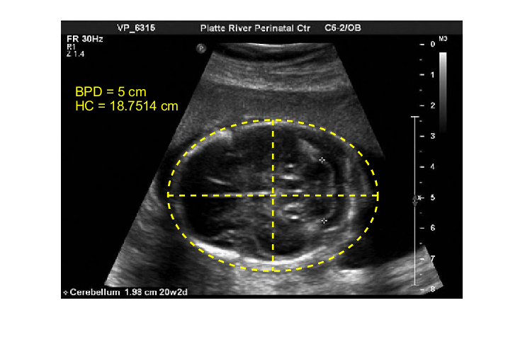 Pengolahan Citra USG untuk Pengukuran Biparietal Diameter (BPD) dan ...